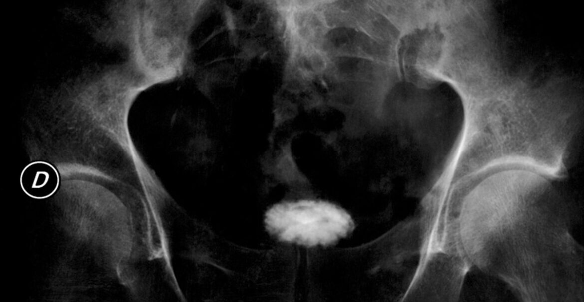 Voiding Dysfunction – Dr. Antoine Khoury